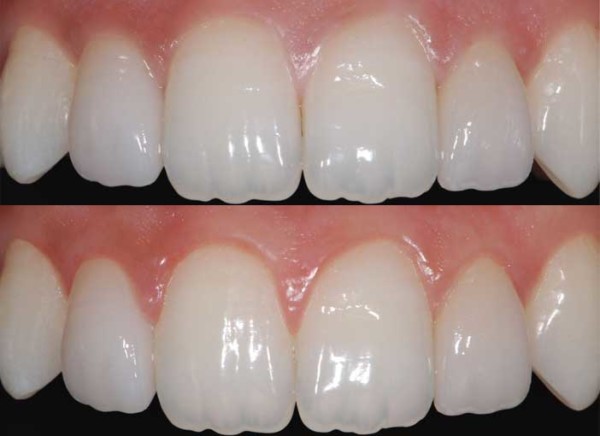 Incisives riziformes gradient thérapeutique et odf, éclaircissement ...