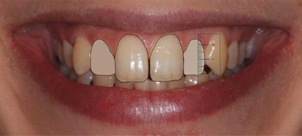 Incisives riziformes gradient thérapeutique et odf, éclaircissement ...