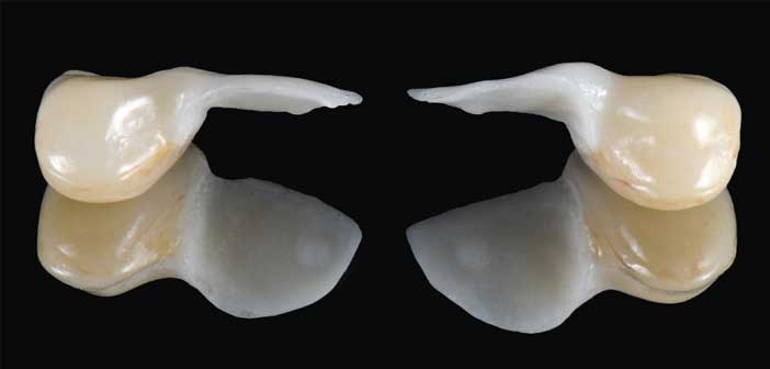 Bridges collés cantilever dans un cas d’agénésie des incisives ...