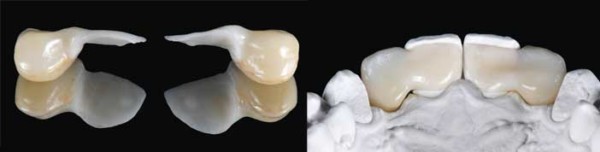 Bridges collés cantilever dans un cas d’agénésie des incisives ...