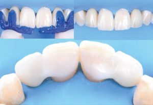 Bridges collés cantilever dans un cas d’agénésie des incisives ...