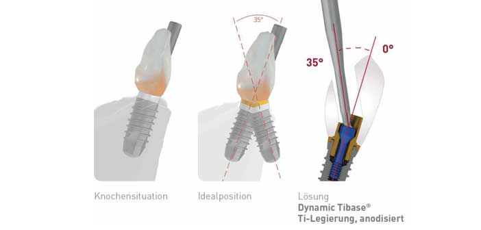 Dynamic tibase® pour thommen medical flexibilite et autonomie dans le ...