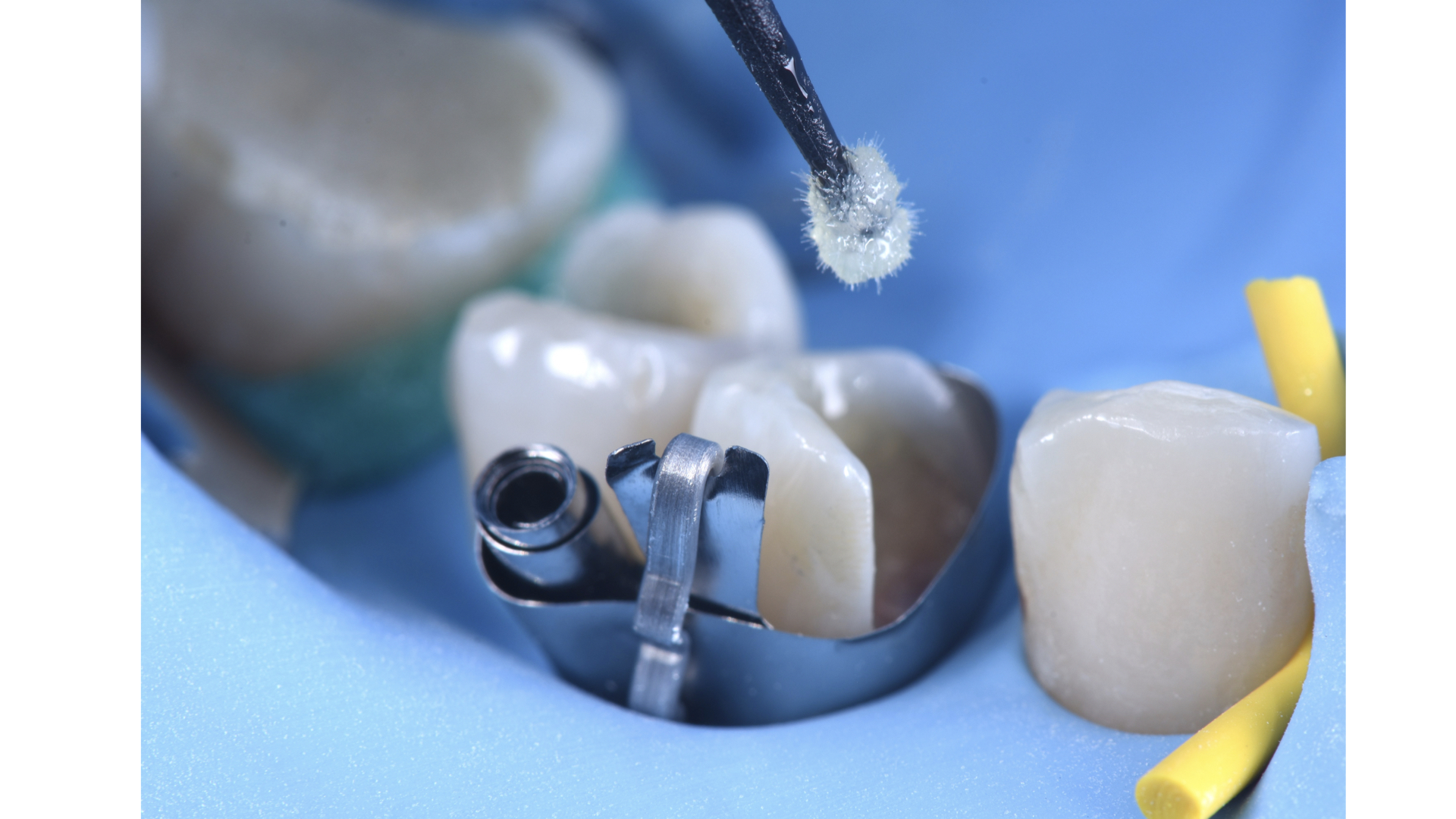 Inlay, Onlay, Overlay de la préparation au collage - LEFILDENTAIRE ...