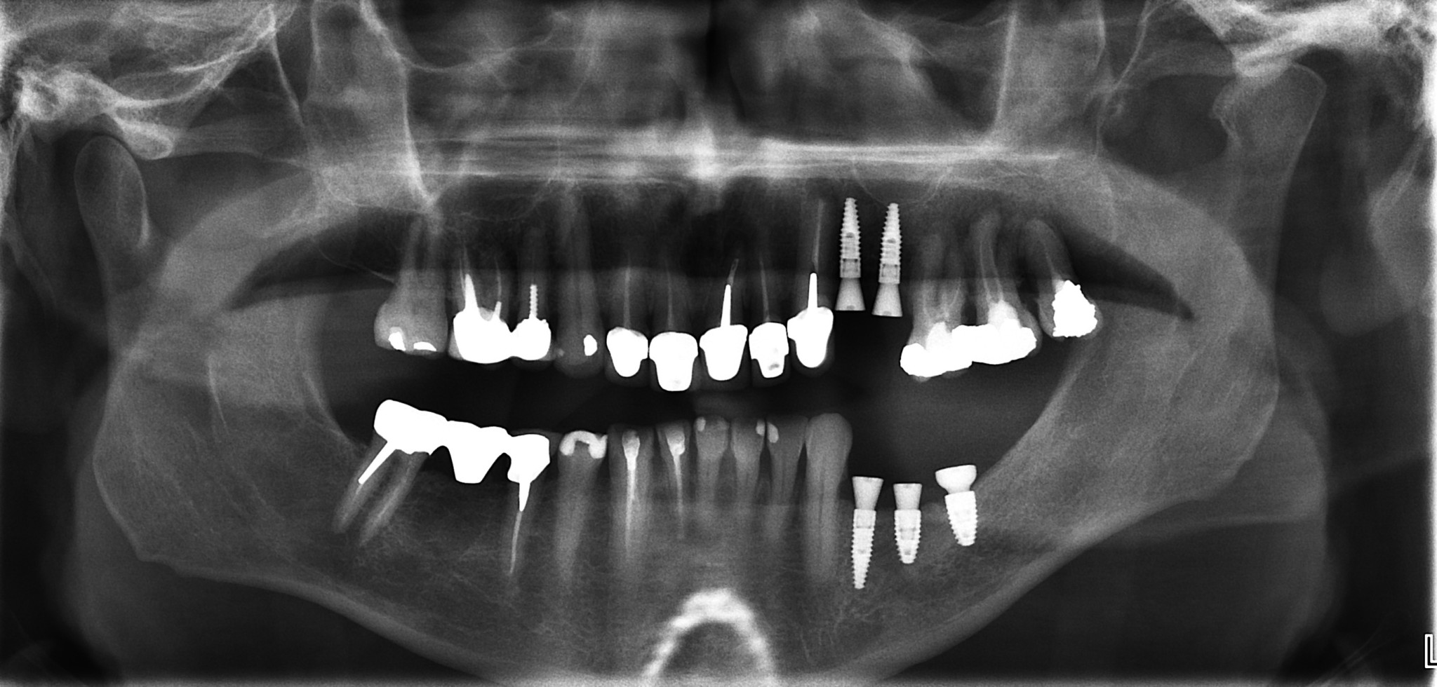 VOLET OSSEUX : l'astuce parfaite pour des économies tissulaires en ...
