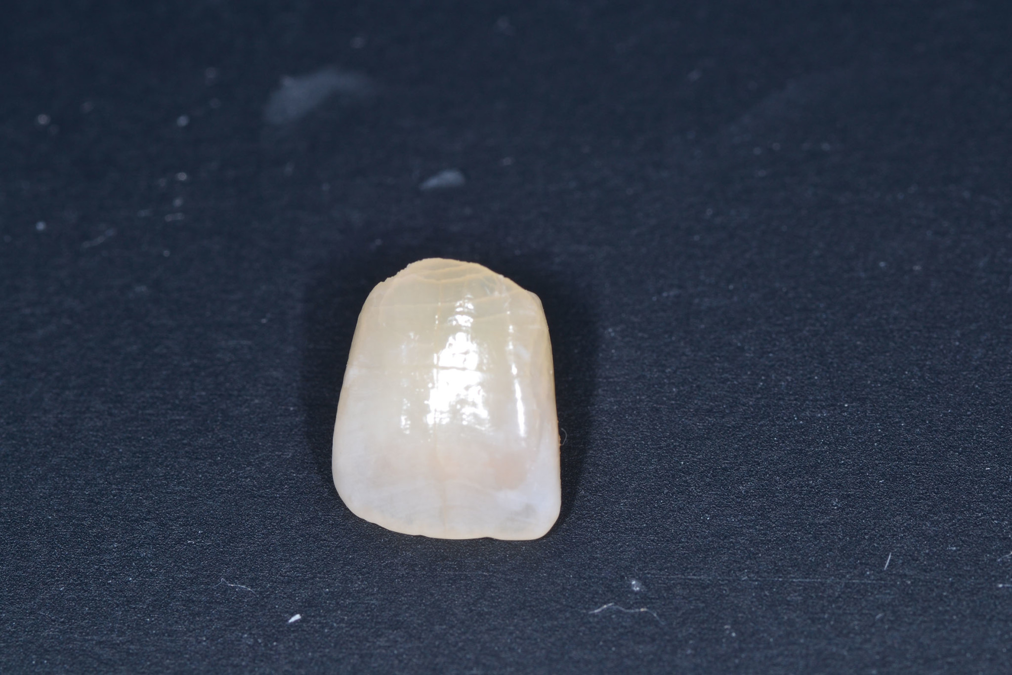 POSE D’UN IMPLANT UNITAIRE ZIRCONIUM - LEFILDENTAIRE magazine dentaire