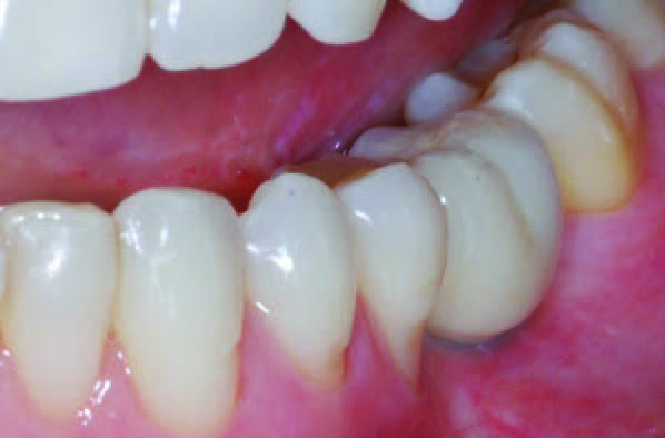 INNOVATION TECHNIQUE ET BIOLOGIQUE : LE PILIER ANATOMIQUE IMPLANTAIRE ...