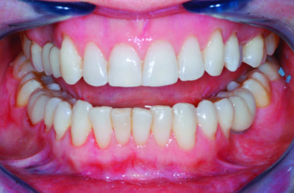 INNOVATION TECHNIQUE ET BIOLOGIQUE : LE PILIER ANATOMIQUE IMPLANTAIRE ...