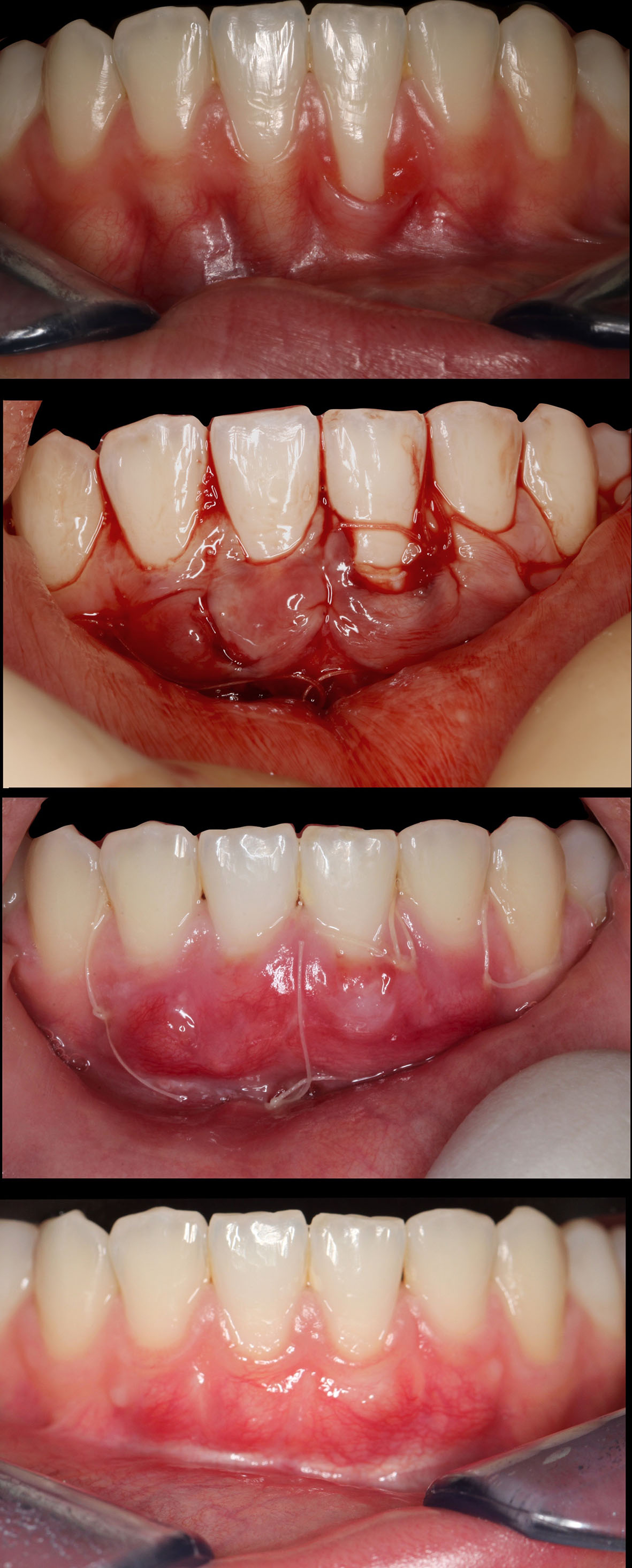 LES NOUVEAUX DÉCOLLEURS POUR TISP ET LA DOUBLE SUTURE SUSPENDUE ...