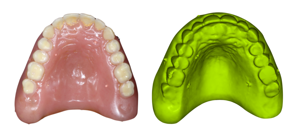 FLUX NUMÉRIQUE POUR LE TRAITEMENT D’UN ÉDENTEMENT COMPLET MAXILLAIRE ...
