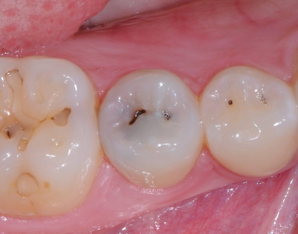 NANOFILL UNIQUE LE COMPOSITE NANO-CHARGÉ UNIVERSEL DE RESTAURATION ...