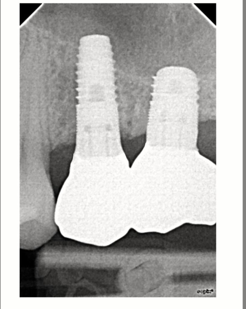 LES IMPLANTS COURTS AU MAXILLAIRE POSTERIEUR : UNE ALTERNATIVE ...