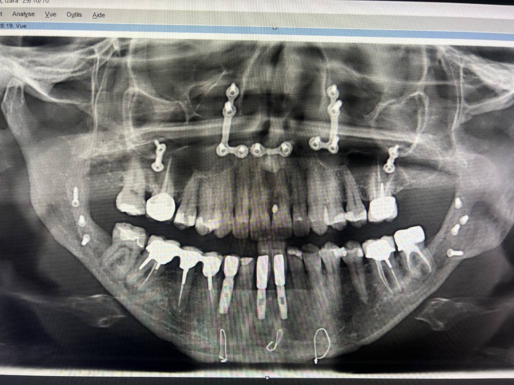 Implant versus Bridge collé pour le remplacement d’une incisive ...