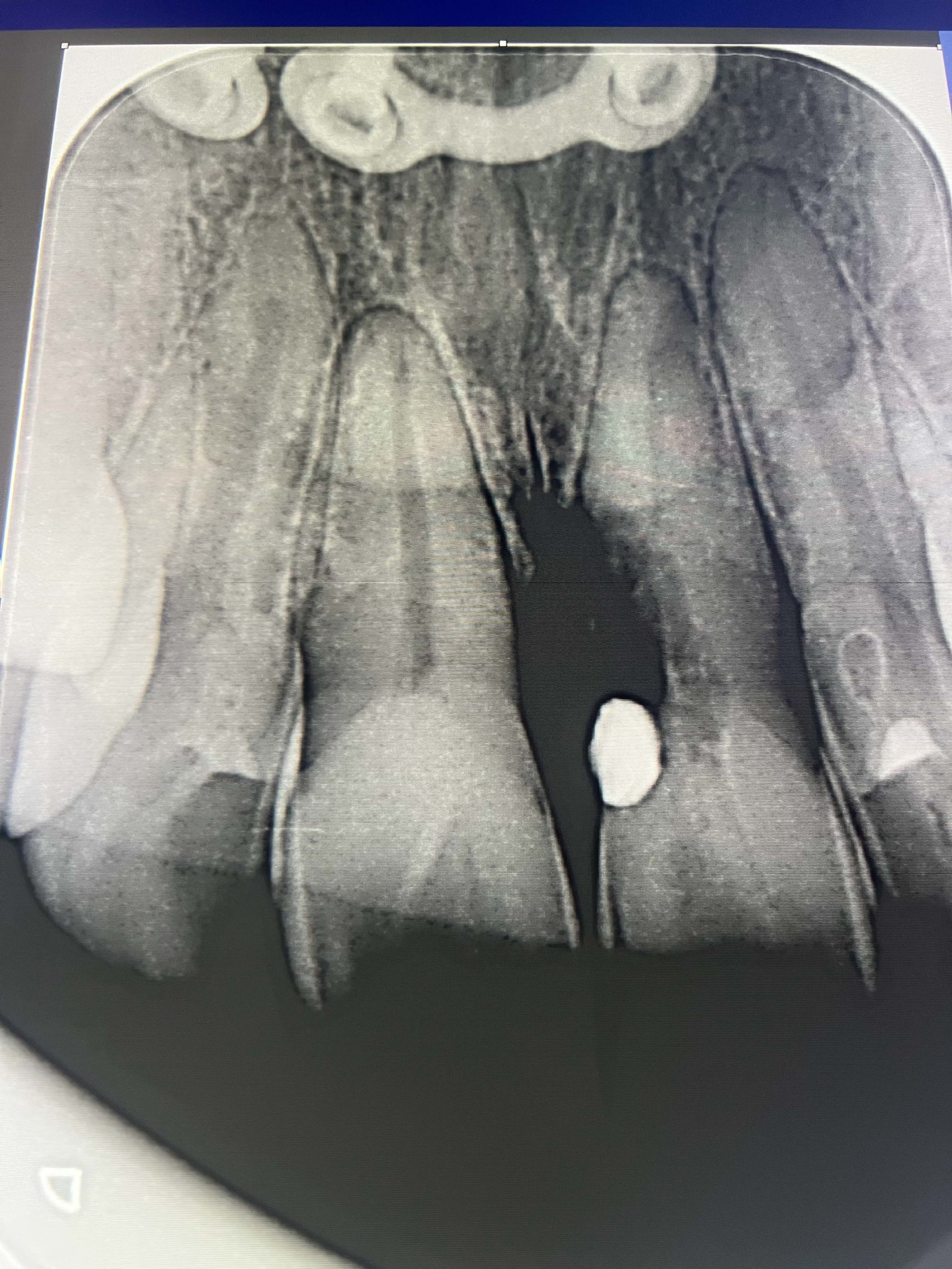 Implant versus Bridge collé pour le remplacement d’une incisive ...