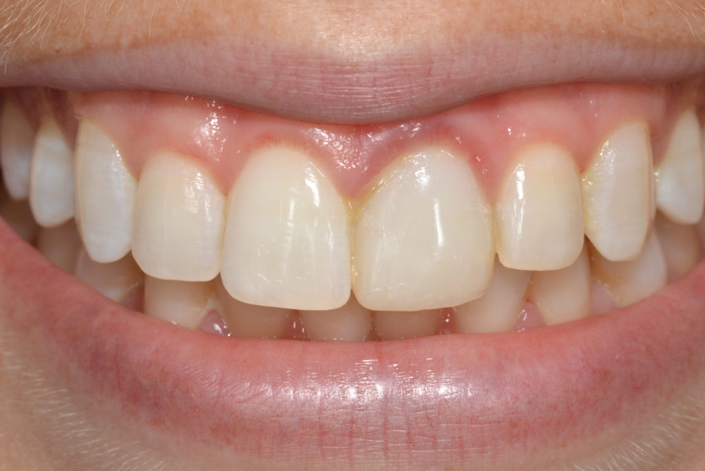 REMPLACEMENT D’UNE INCISIVE CENTRALE AU MAXILLAIRE INTÉRÊT DE L’IMPLANT ...