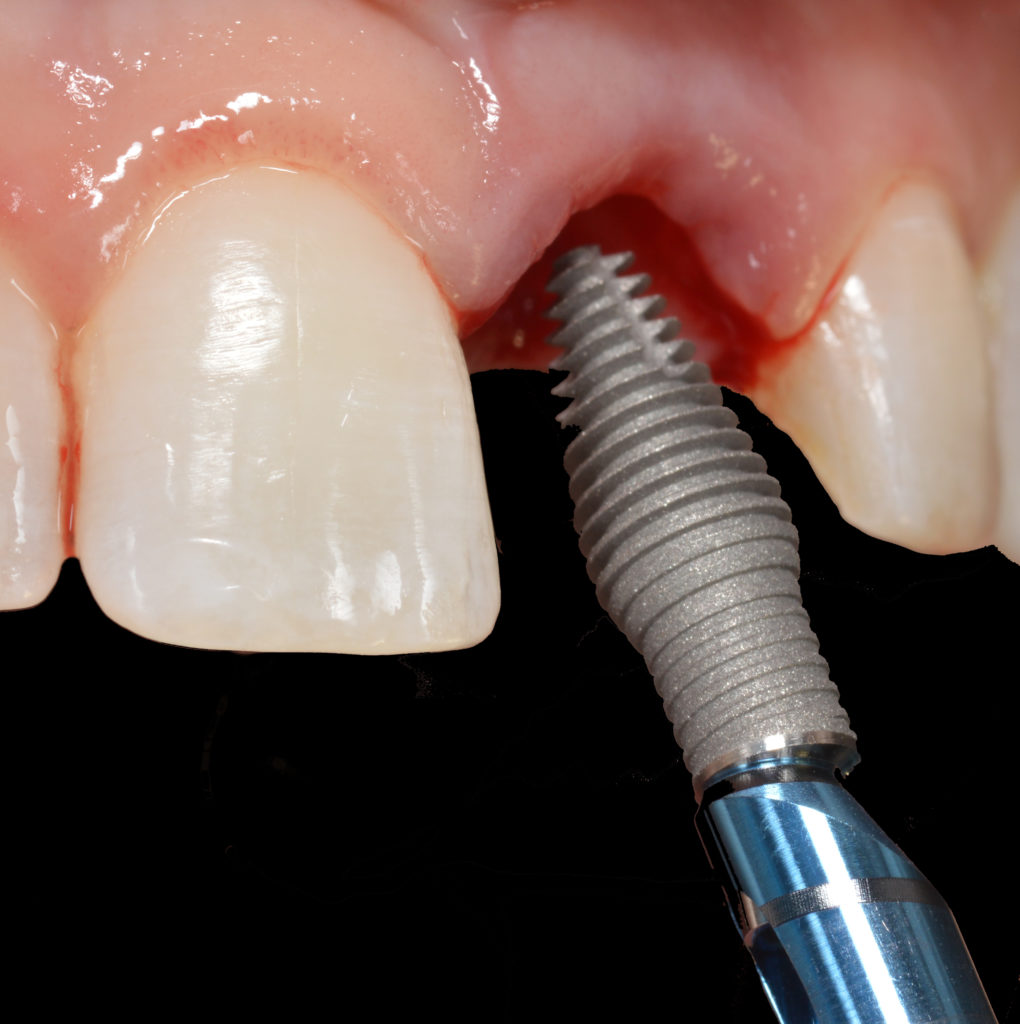 REMPLACEMENT D’UNE INCISIVE CENTRALE AU MAXILLAIRE INTÉRÊT DE L’IMPLANT ...