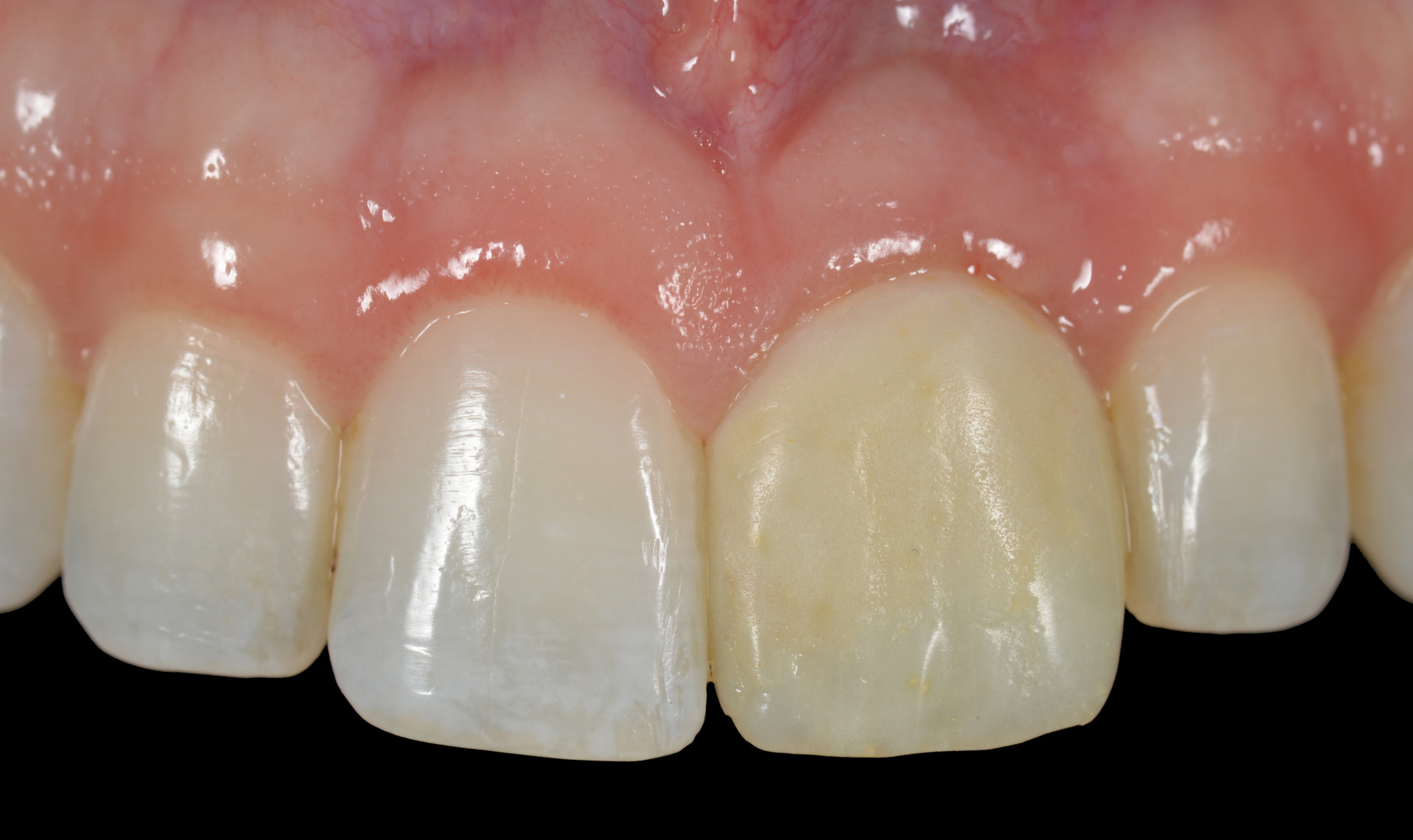 REMPLACEMENT D’UNE INCISIVE CENTRALE AU MAXILLAIRE INTÉRÊT DE L’IMPLANT ...