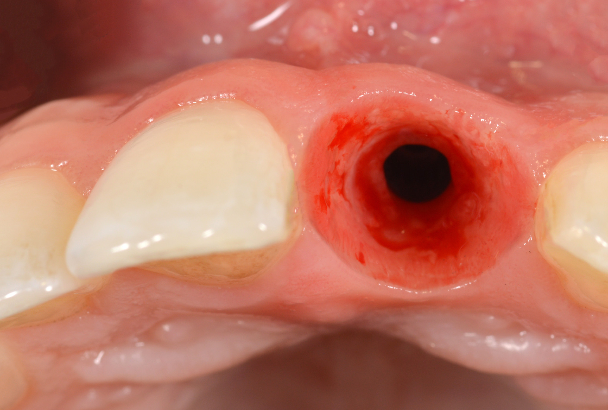 REMPLACEMENT D’UNE INCISIVE CENTRALE AU MAXILLAIRE INTÉRÊT DE L’IMPLANT ...