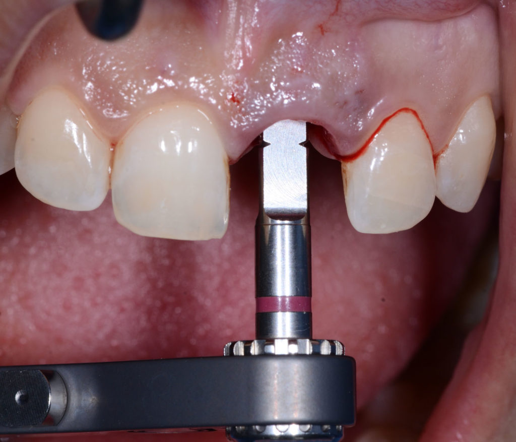 INTÉRÊT DU SYSTÈME V3, MIS DENTSPLY EN ZONE ESTHÉTIQUE - LEFILDENTAIRE ...