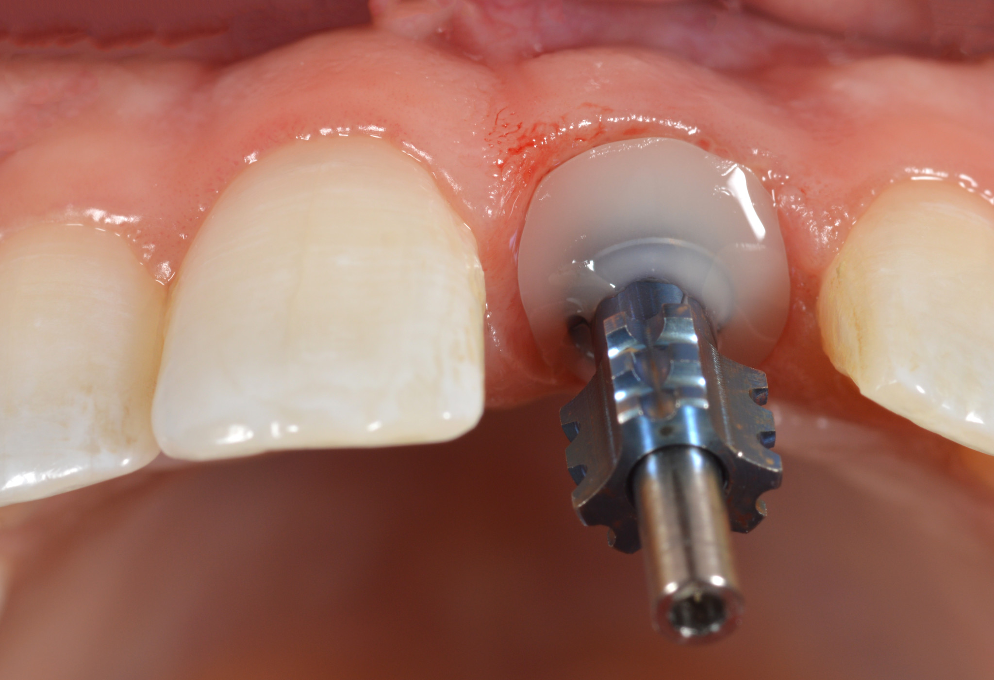 REMPLACEMENT D’UNE INCISIVE CENTRALE AU MAXILLAIRE INTÉRÊT DE L’IMPLANT ...
