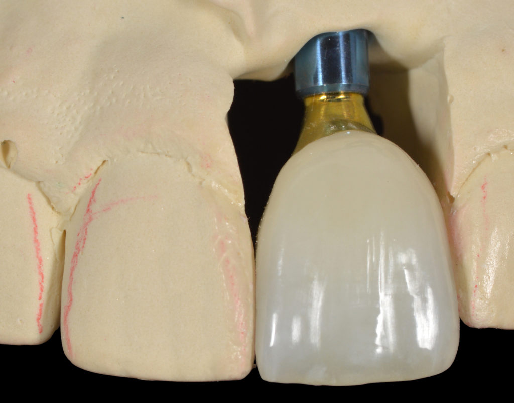 REMPLACEMENT D’UNE INCISIVE CENTRALE AU MAXILLAIRE INTÉRÊT DE L’IMPLANT ...