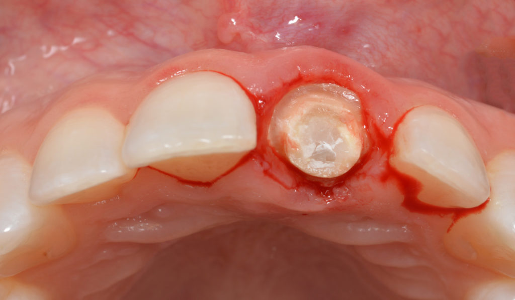 REMPLACEMENT D’UNE INCISIVE CENTRALE AU MAXILLAIRE INTÉRÊT DE L’IMPLANT ...