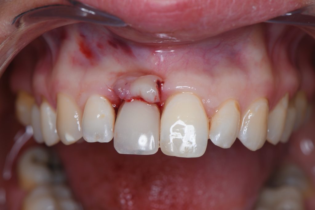CONFORMATION DU VOLUME TISSULAIRE PÉRI-IMPLANTAIRE SANS GREFFE ...