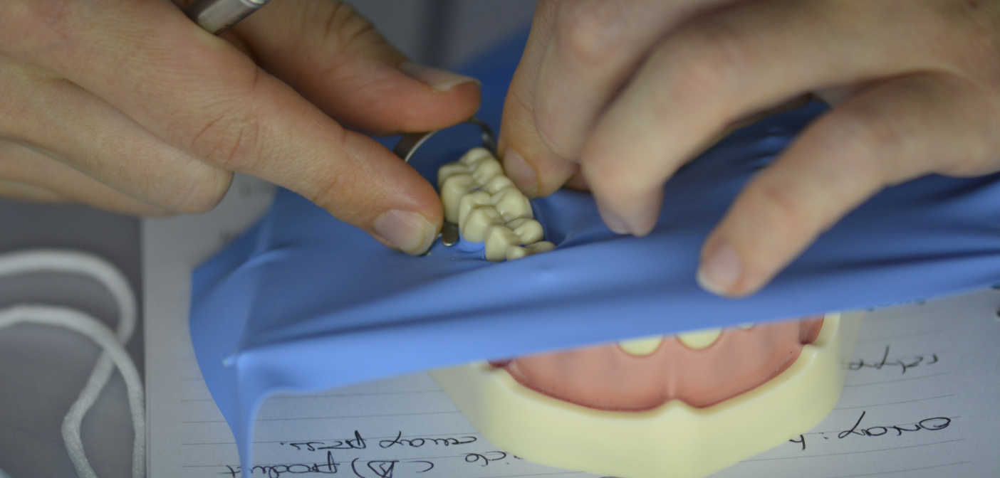 Inlay, Onlay, Overlay : de la préparation au collage - LEFILDENTAIRE ...