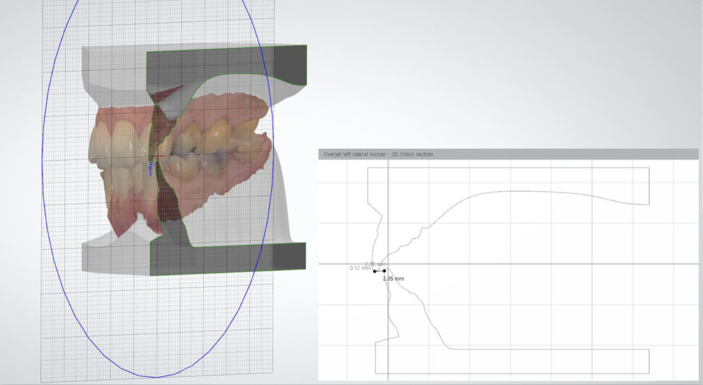 LA RÉVOLUTION DIGITALE EN ORTHODONTIE - LEFILDENTAIRE magazine dentaire