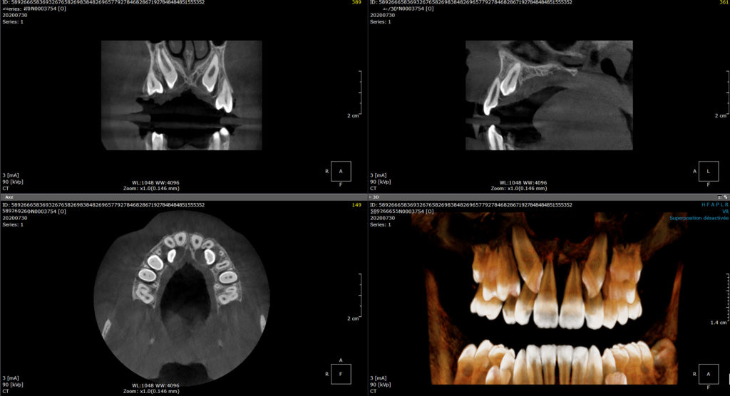 INTÉRÊTS DU CBCT DANS DANS L’ORTHODONTIE NUMÉRIQUE - LEFILDENTAIRE ...