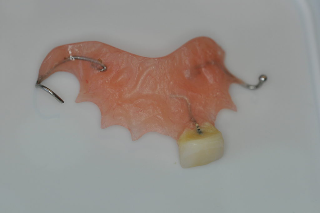 CHIRURGIE RECONSTRUCTRICE PRÉ IMPLANTAIRE ET PRÉLÈVEMENT OSSEUX GUIDÉ ...