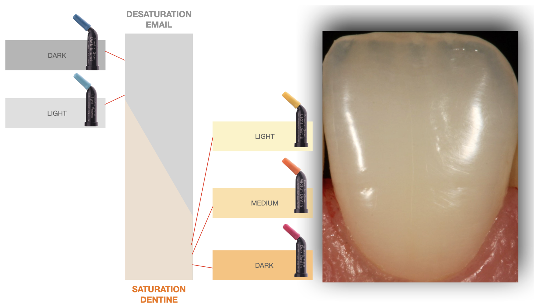 STRATIFICATION DES COMPOSITES EN ANTÉRIEUR : SIMPLIFICATION ET NOUVEAUX ...