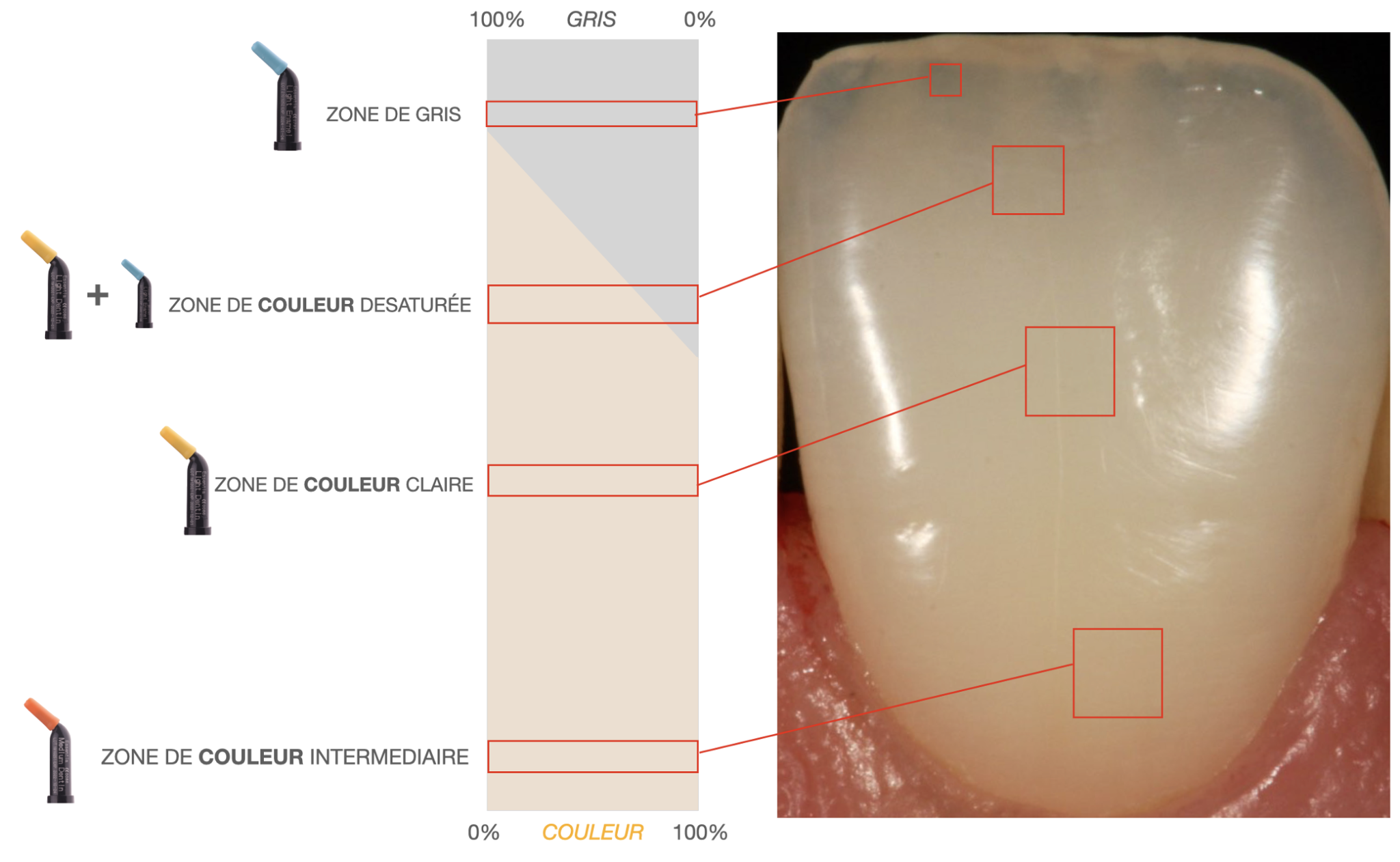 STRATIFICATION DES COMPOSITES EN ANTÉRIEUR : SIMPLIFICATION ET NOUVEAUX ...