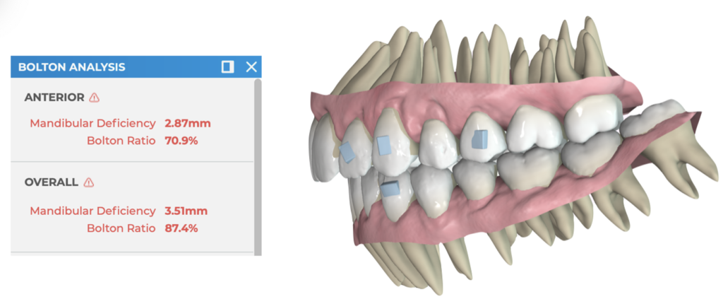 LES DYSHARMONIES DENTO DENTAIRES : UN PROBLÈME ORTHODONTIQUE POUR UNE ...