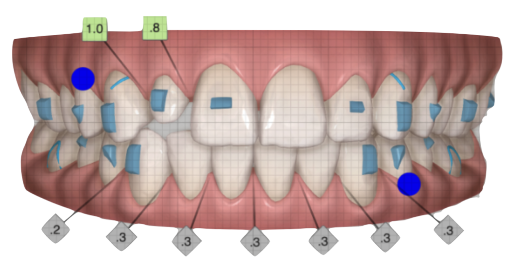 LES DYSHARMONIES DENTO DENTAIRES : UN PROBLÈME ORTHODONTIQUE POUR UNE ...