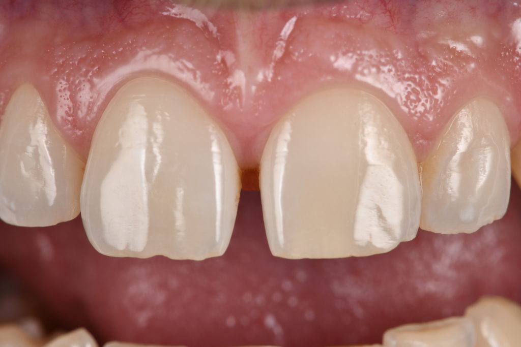 FERMETURE DE DIASTÈME AU COMPOSITE EN TECHNIQUE DIRECTE : LA « FRONT ...