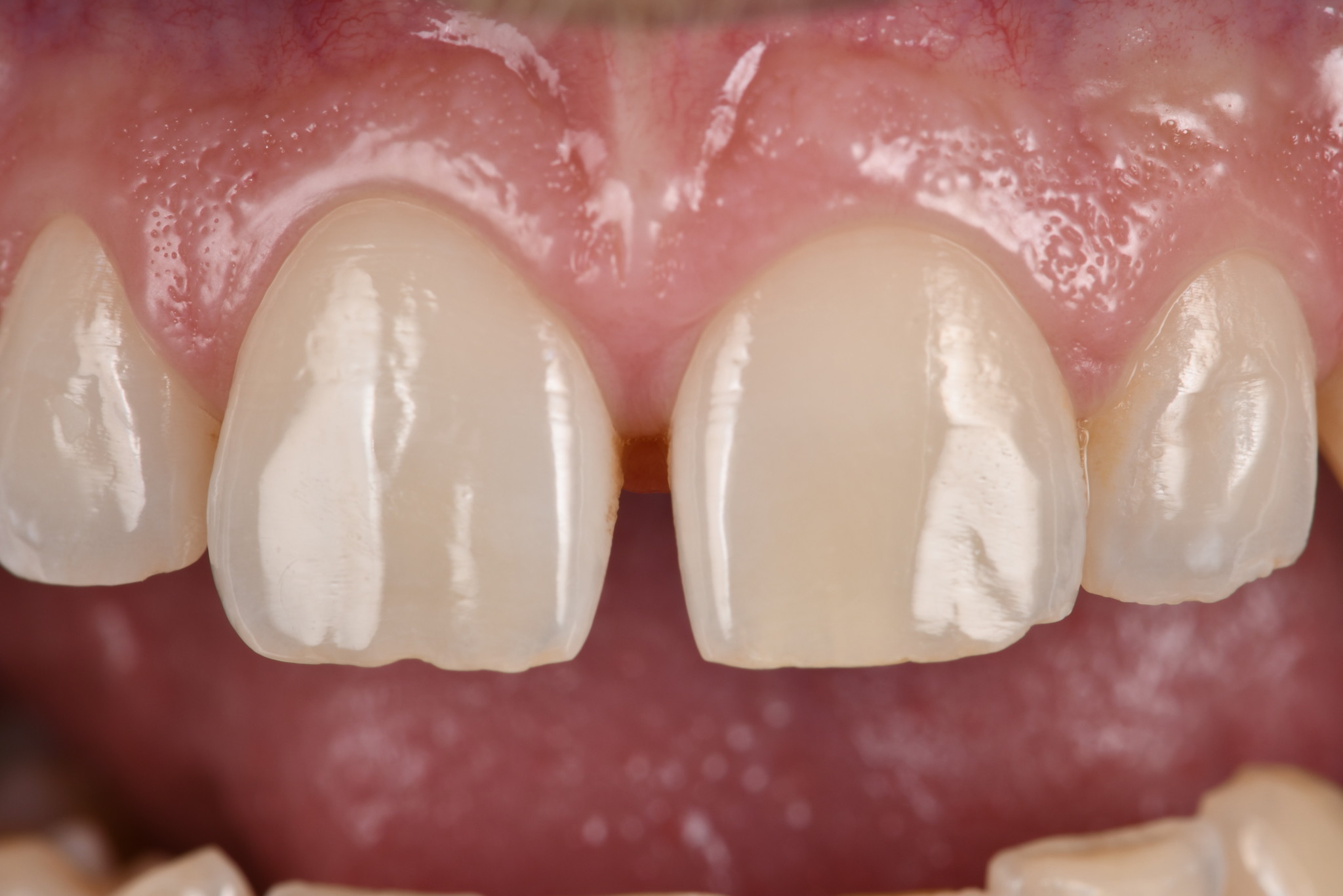 FERMETURE DE DIASTÈME AU COMPOSITE EN TECHNIQUE DIRECTE : LA « FRONT ...