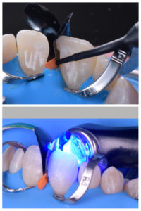 FERMETURE DE DIASTÈME AU COMPOSITE EN TECHNIQUE DIRECTE : LA « FRONT ...