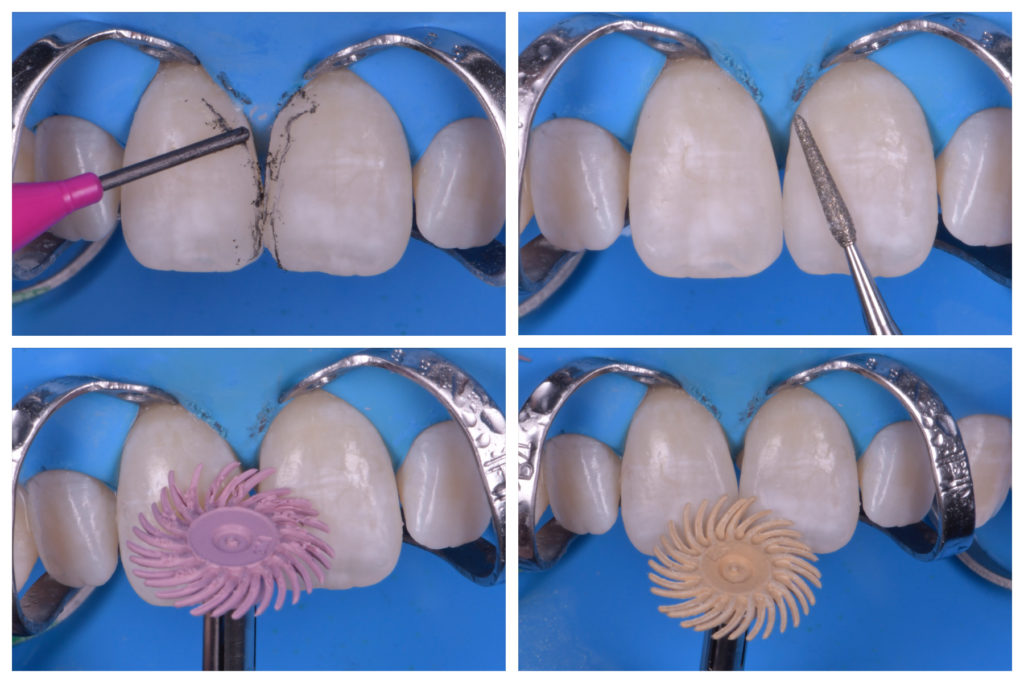 FERMETURE DE DIASTÈME AU COMPOSITE EN TECHNIQUE DIRECTE : LA « FRONT ...