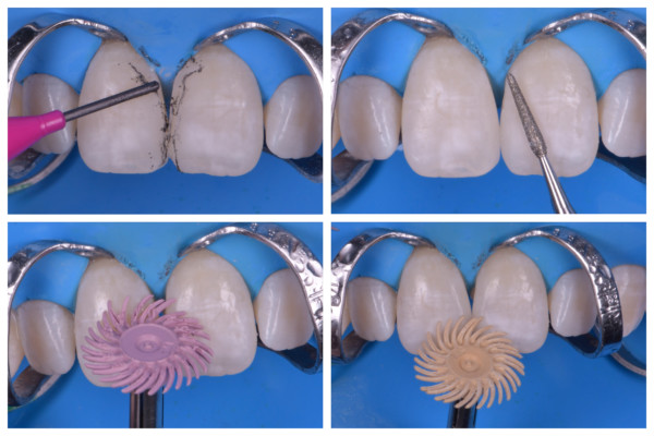 FERMETURE DE DIASTÈME AU COMPOSITE EN TECHNIQUE DIRECTE : LA « FRONT ...