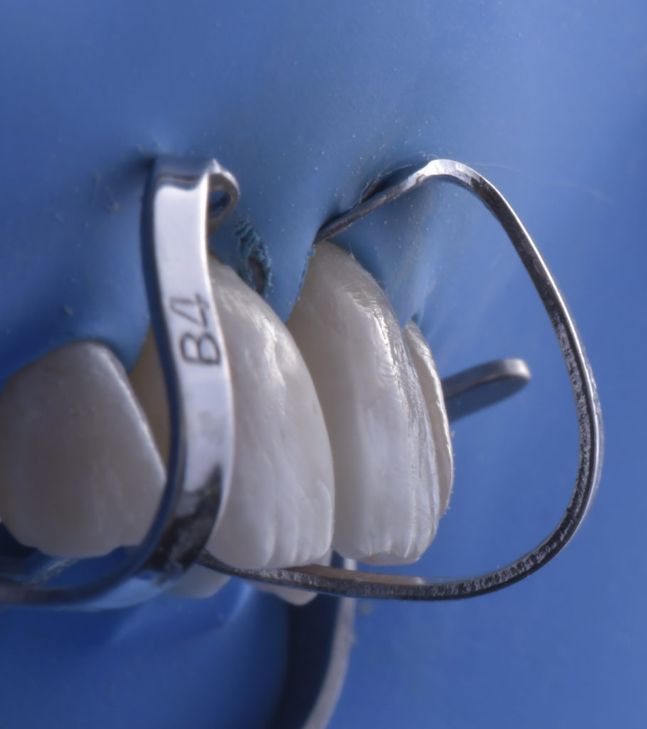 FERMETURE DE DIASTÈME AU COMPOSITE EN TECHNIQUE DIRECTE : LA « FRONT ...