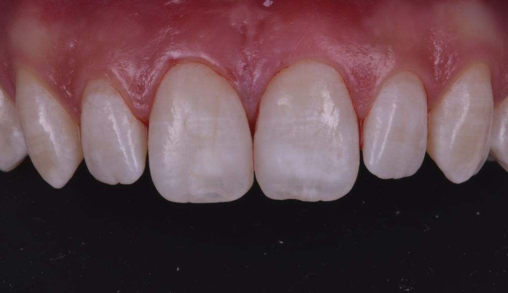 FERMETURE DE DIASTÈME AU COMPOSITE EN TECHNIQUE DIRECTE : LA « FRONT ...