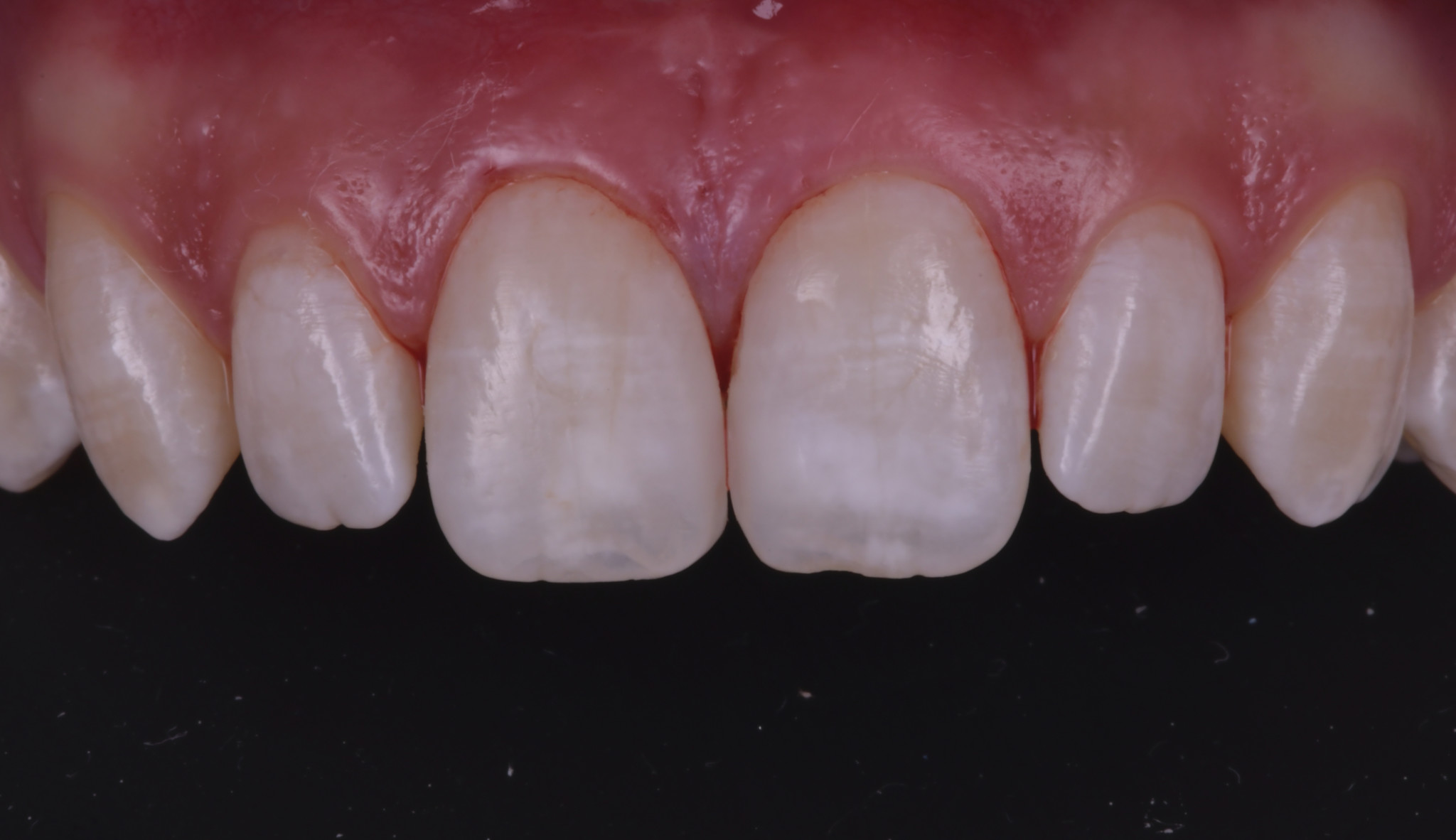 FERMETURE DE DIASTÈME AU COMPOSITE EN TECHNIQUE DIRECTE : LA « FRONT ...