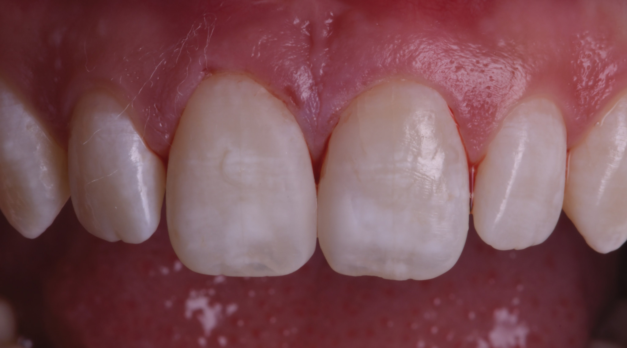 FERMETURE DE DIASTÈME AU COMPOSITE EN TECHNIQUE DIRECTE : LA « FRONT ...