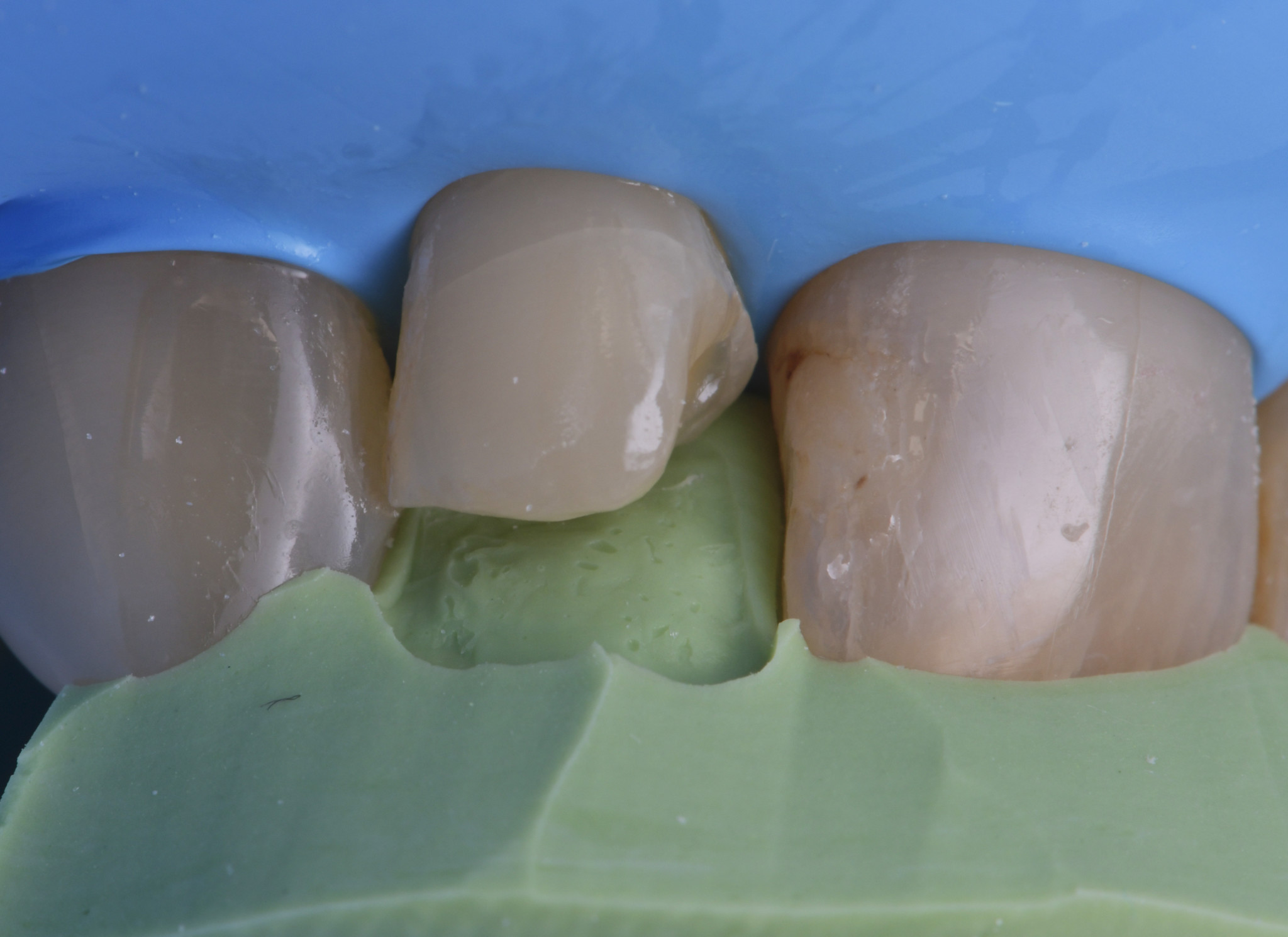 FERMETURE DE DIASTÈME AU COMPOSITE EN TECHNIQUE DIRECTE : LA « FRONT ...