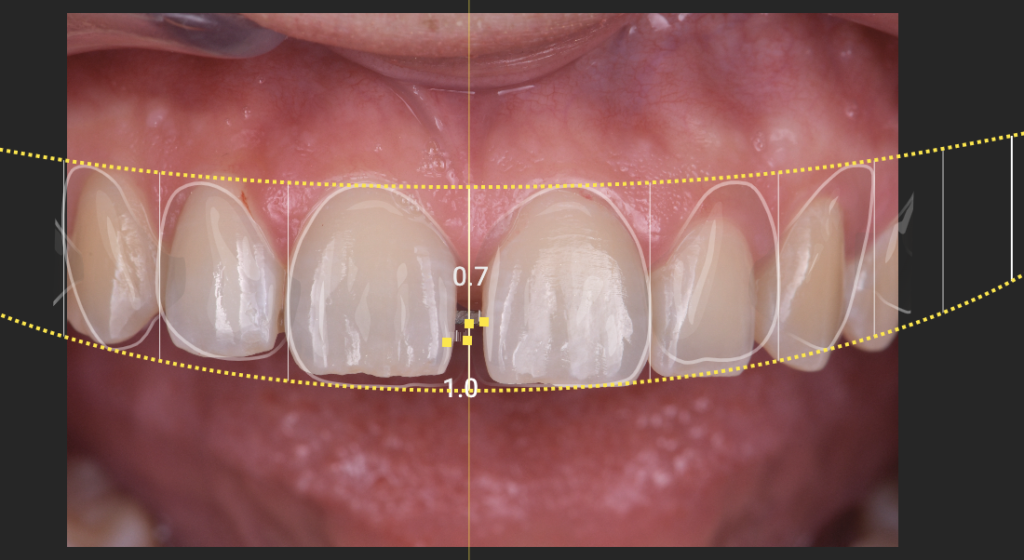 FERMETURE DE DIASTÈME AU COMPOSITE EN TECHNIQUE DIRECTE : LA « FRONT ...