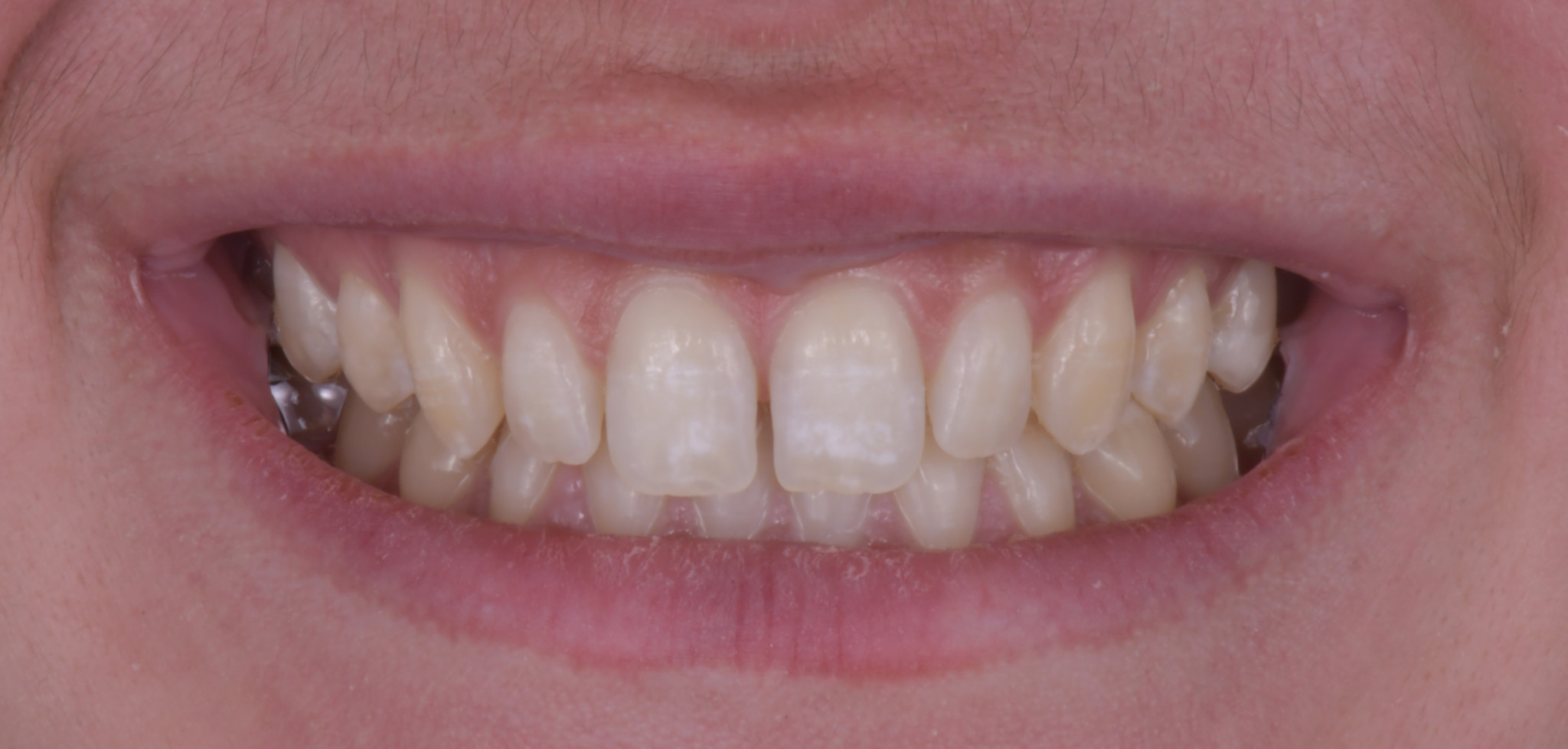 FERMETURE DE DIASTÈME AU COMPOSITE EN TECHNIQUE DIRECTE : LA « FRONT ...