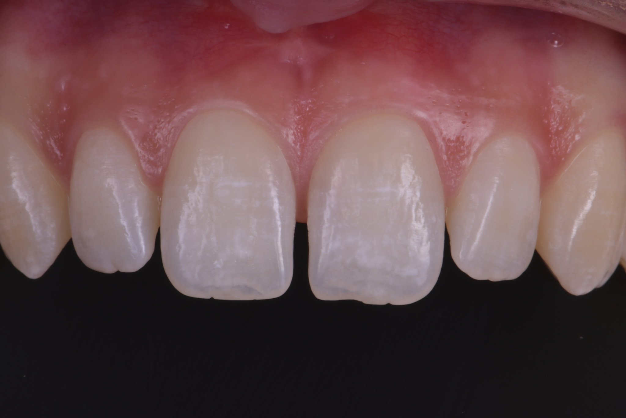 FERMETURE DE DIASTÈME AU COMPOSITE EN TECHNIQUE DIRECTE : LA « FRONT ...