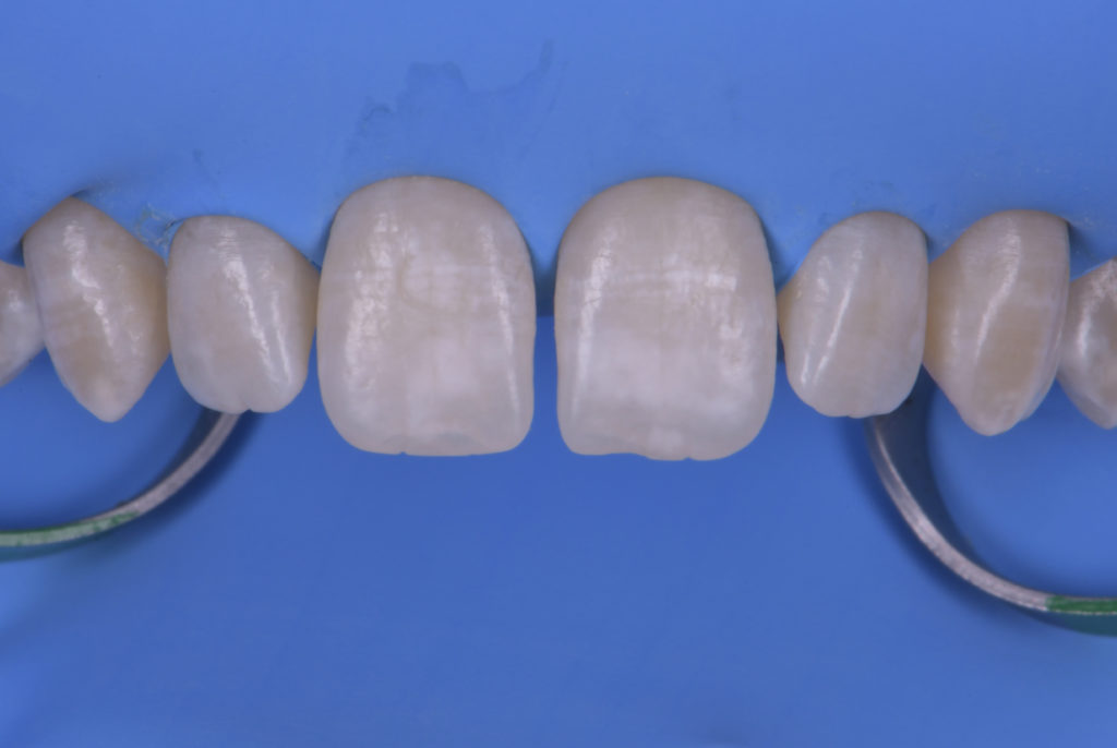 FERMETURE DE DIASTÈME AU COMPOSITE EN TECHNIQUE DIRECTE : LA « FRONT ...