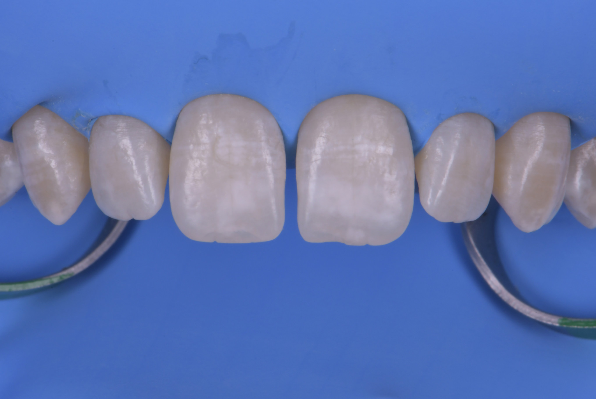 FERMETURE DE DIASTÈME AU COMPOSITE EN TECHNIQUE DIRECTE : LA « FRONT ...