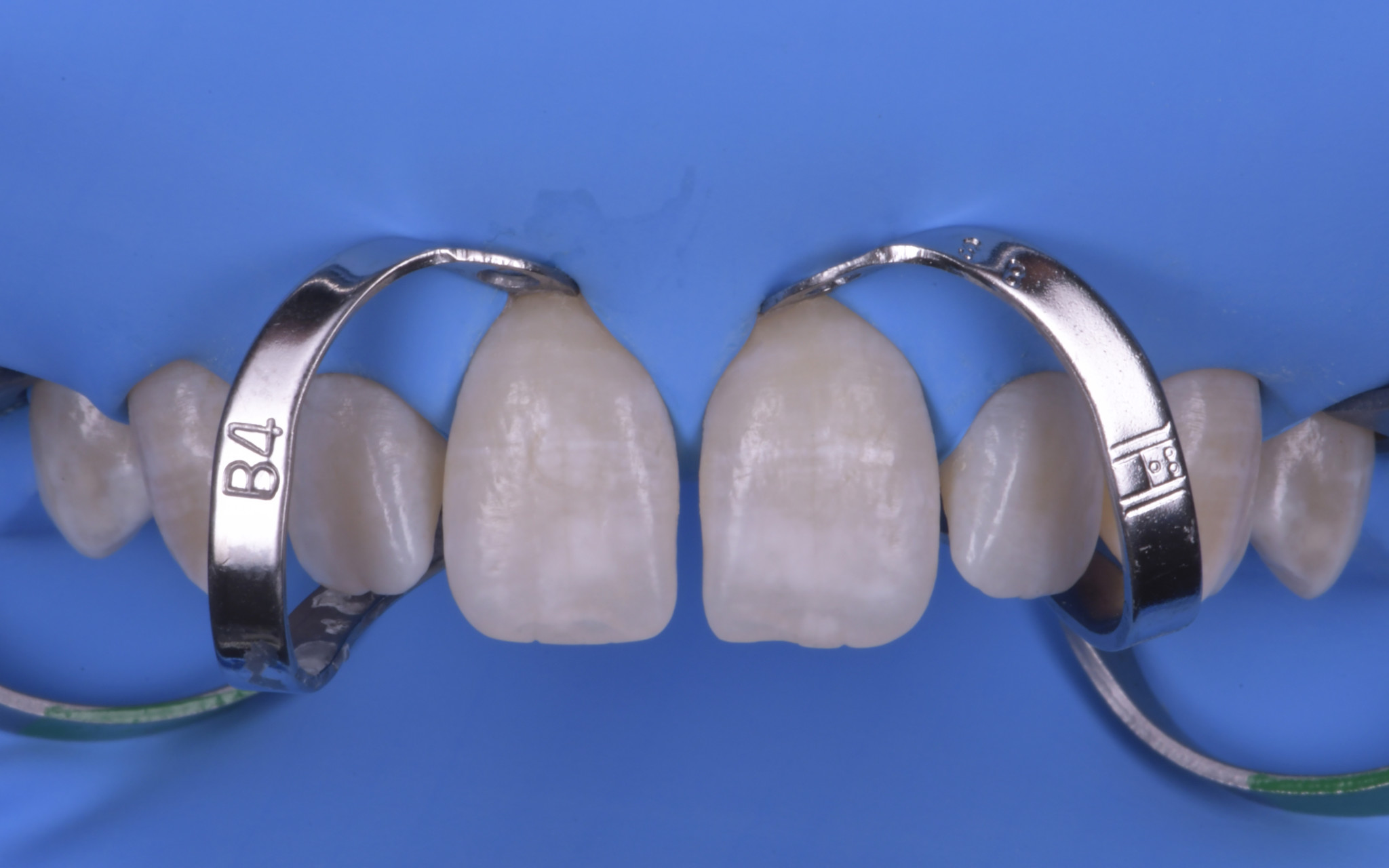 FERMETURE DE DIASTÈME AU COMPOSITE EN TECHNIQUE DIRECTE : LA « FRONT ...